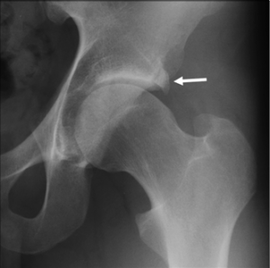 Femoroacetabular Impingement (FAI) - Hip Arthroscopy Australia